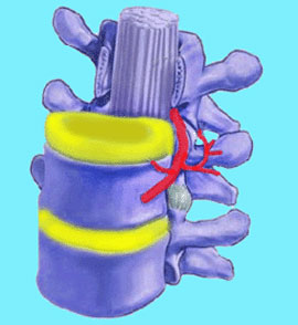 foraminal-narrowing-41 - Spinal Stenosis